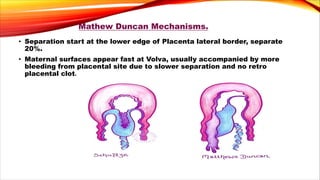 THIRD STAGE OF LABOUR AND ITS MANAGEMENT.pdf