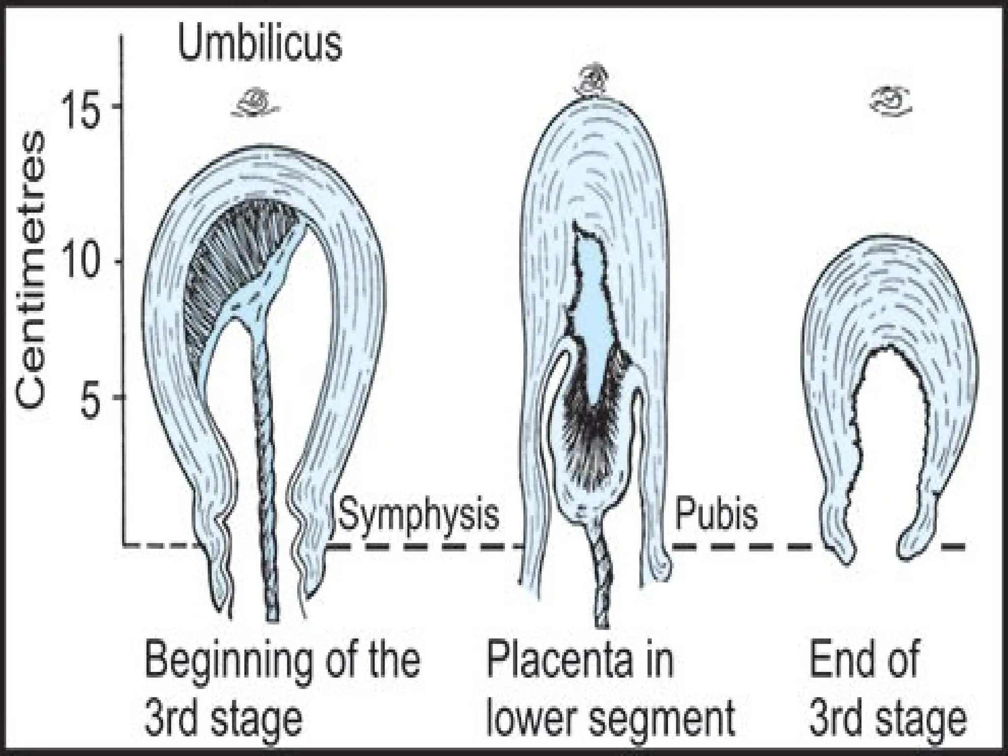 Third Stage of Labour.pptx methods of placental expulsion | PPTX