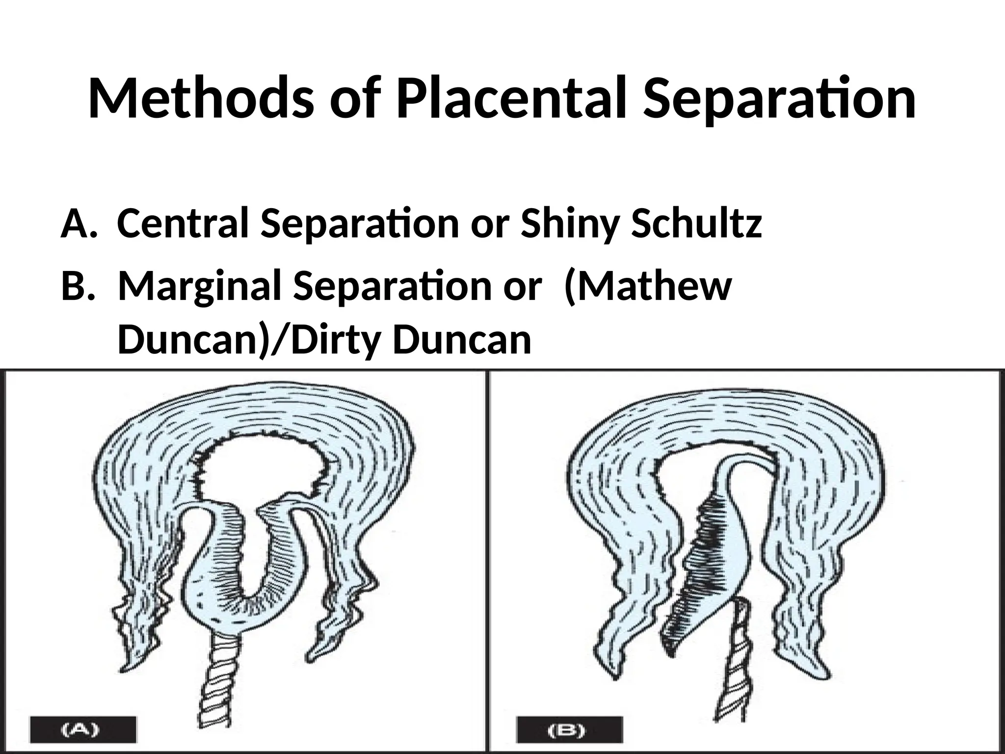 Third Stage of Labour.pptx methods of placental expulsion | PPTX