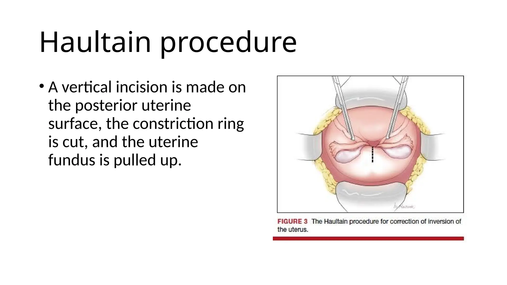 Third stage of labour complications.pptx