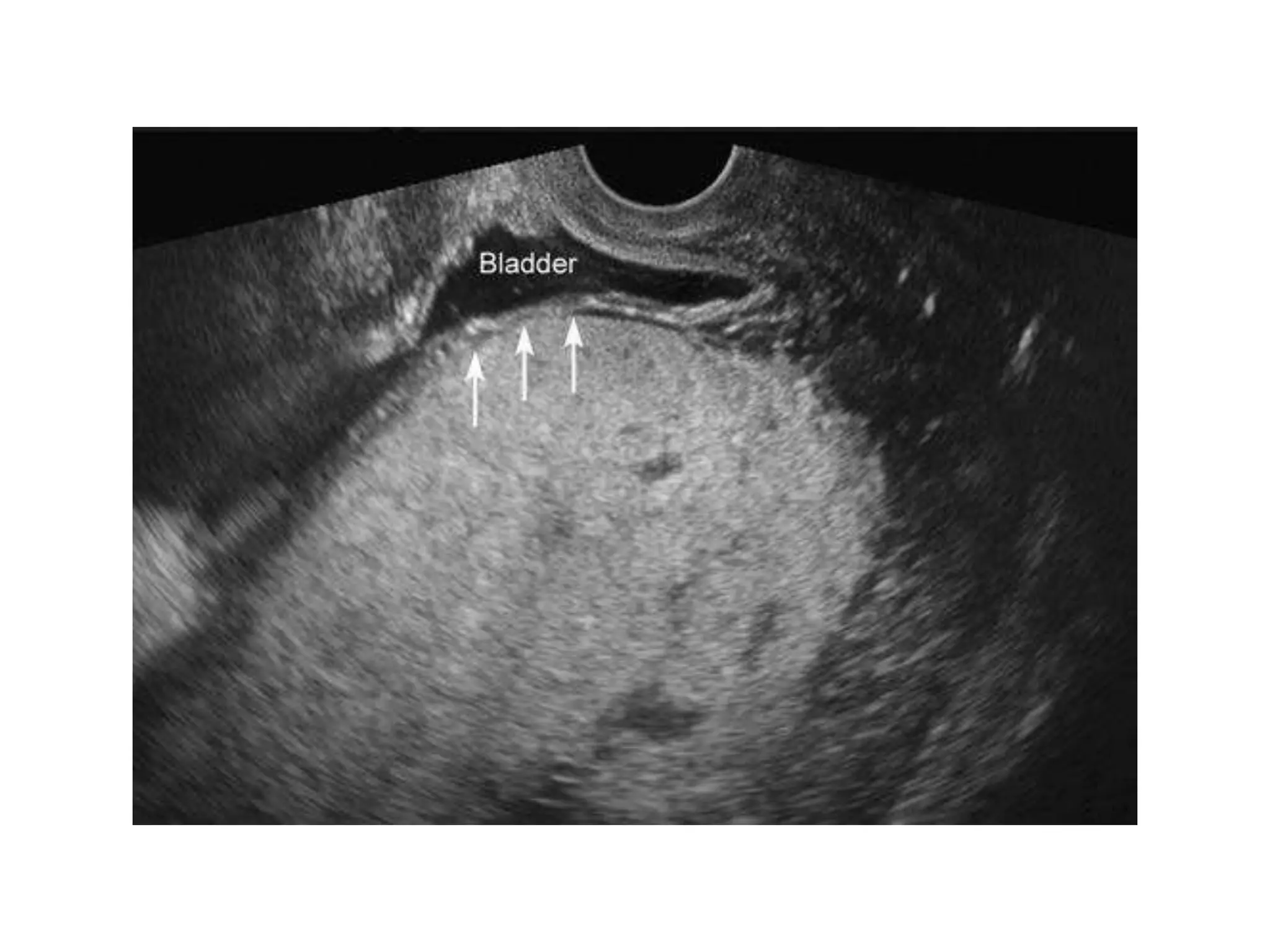 ultrasound of second and third trimester bleeding | PPTX
