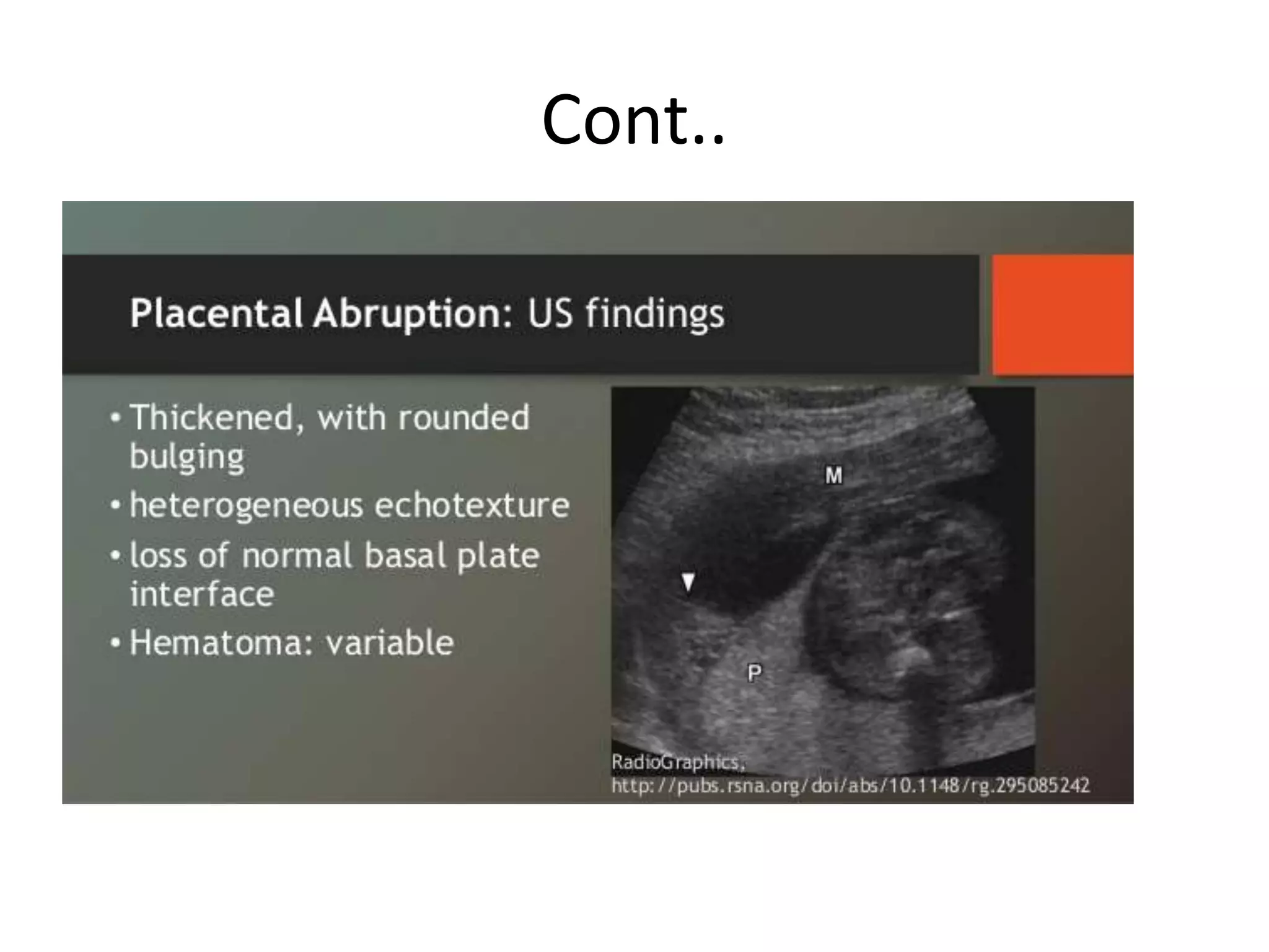 ultrasound of second and third trimester bleeding | PPTX