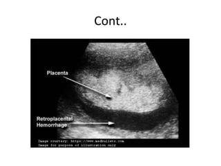Retroplacental Bleeding