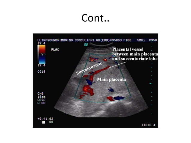 ultrasound of second and third trimester bleeding | PPTX | Pregnancy ...