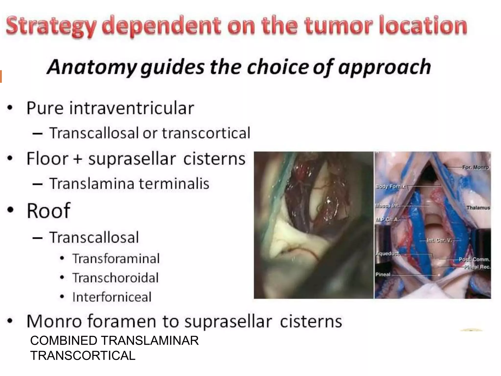 Third ventricle surgical anatomy and approaches | PPTX