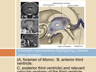 Third ventricle surgical anatomy and approaches | PPTX