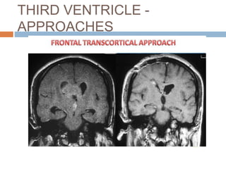 Third ventricle surgical anatomy and approaches | PPTX