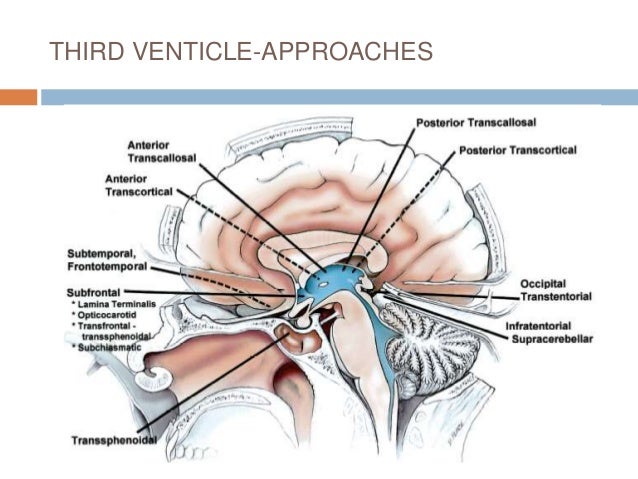 Third ventricle surgical anatomy and approaches