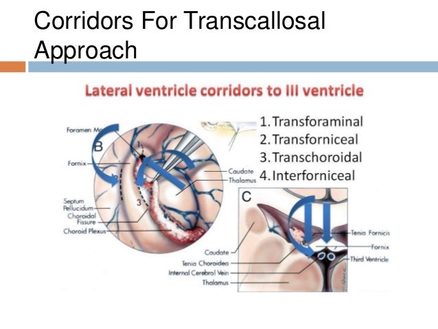 Third Ventricle Surgical Anatomy And Approaches