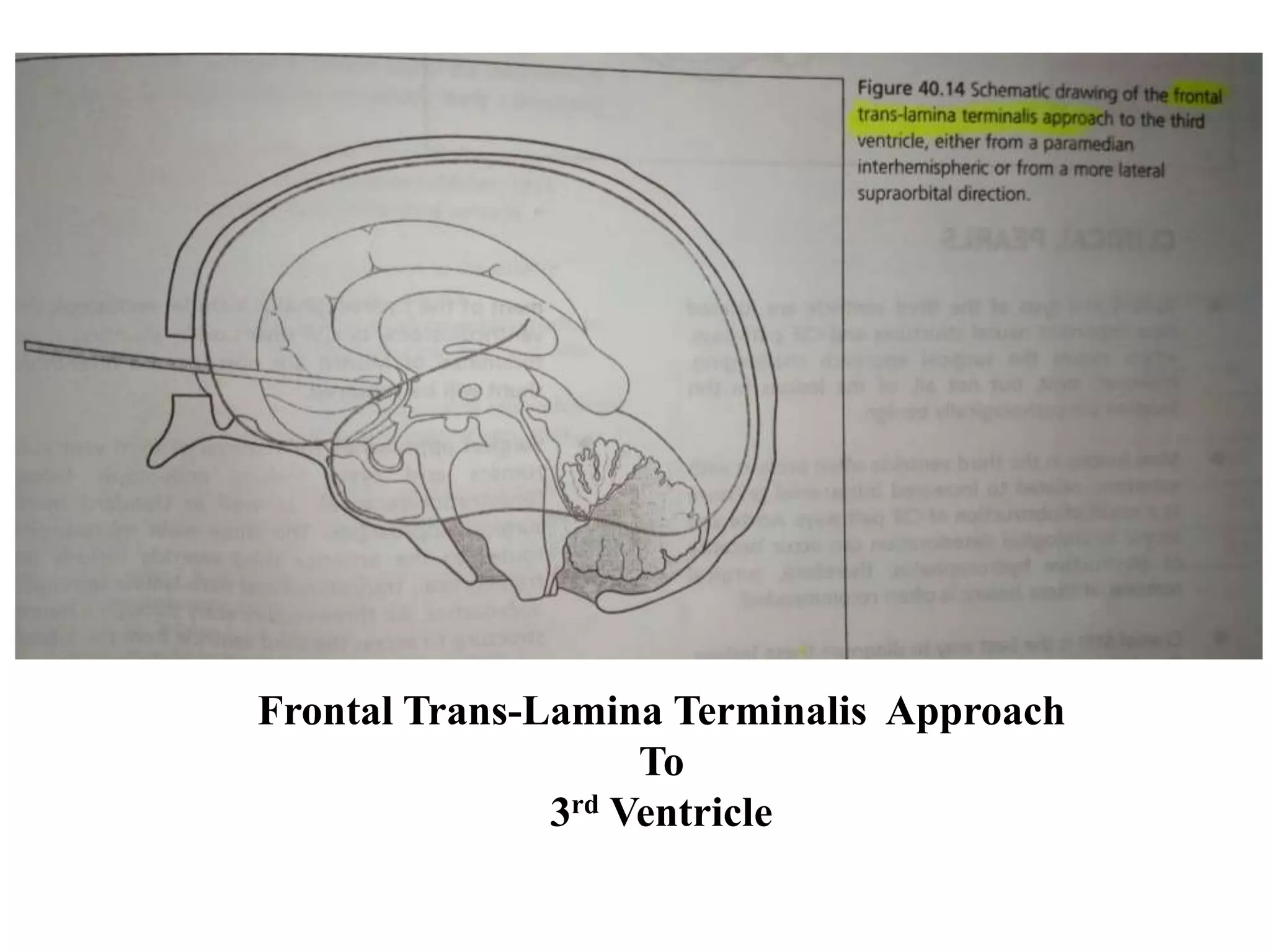 Third ventricle | PPTX