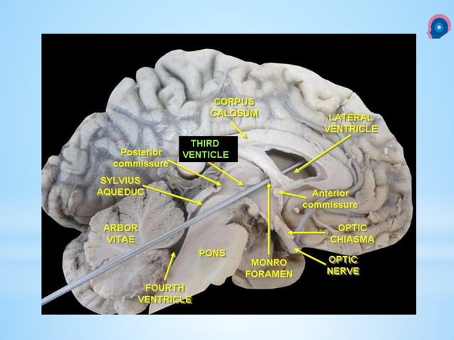 Third ventricular surgical approaches | PPTX
