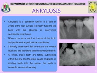 third year etiology of malocclusion.pptx
