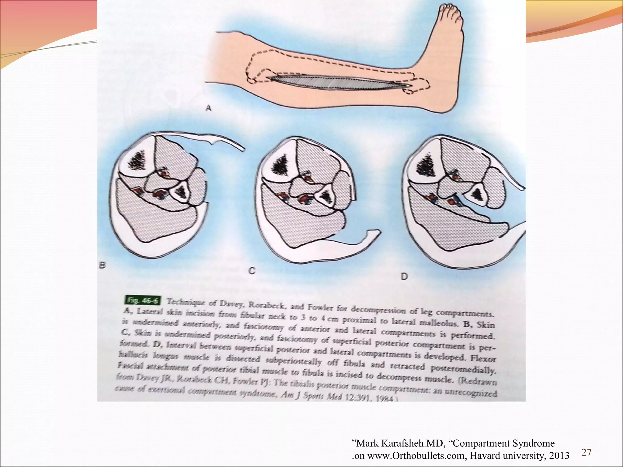 Compartment syndrome, acute, chronic, anatomy and operation | PPT