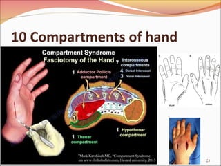 Compartment syndrome, acute, chronic, anatomy and operation | PPT