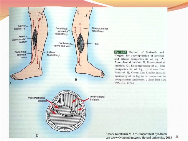 Compartment syndrome, acute, chronic, anatomy and operation | PPT