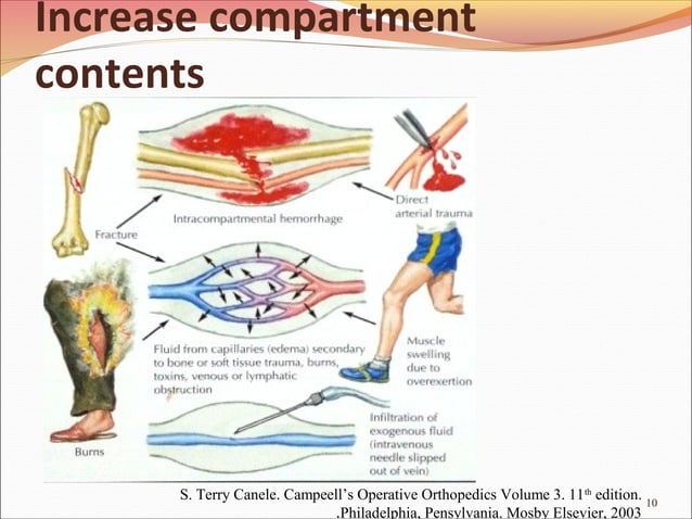 Compartment syndrome, acute, chronic, anatomy and operation