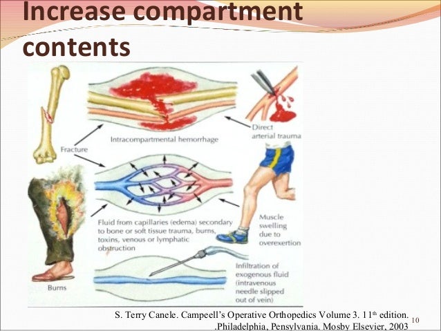 Compartment syndrome, acute, chronic, anatomy and operation