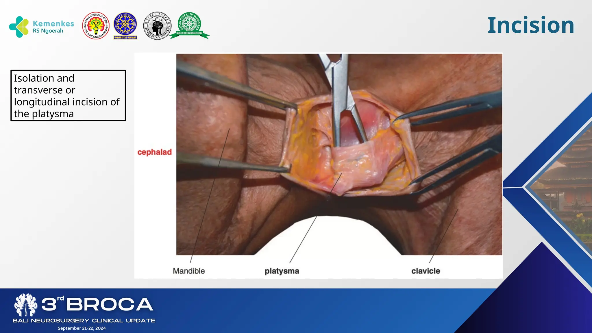 Comprehensive management of traumatic HNP.pptx