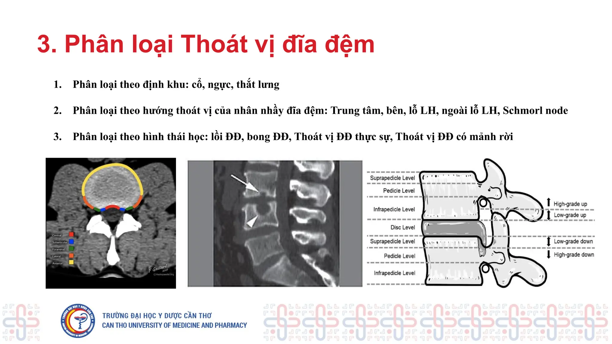 TIEP CAN CHAN DOAN THOÁT VỊ ĐĨA ĐỆM.pdf