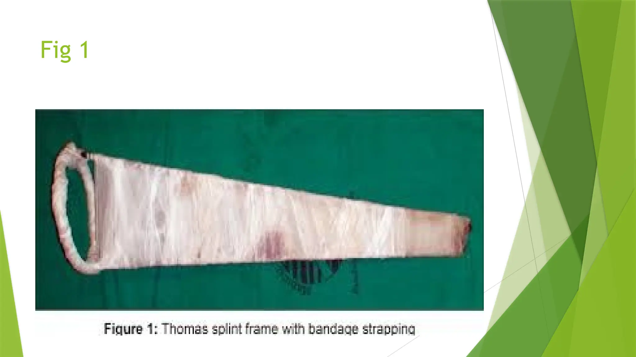 lower limns splinting, Thomas splint.pptx