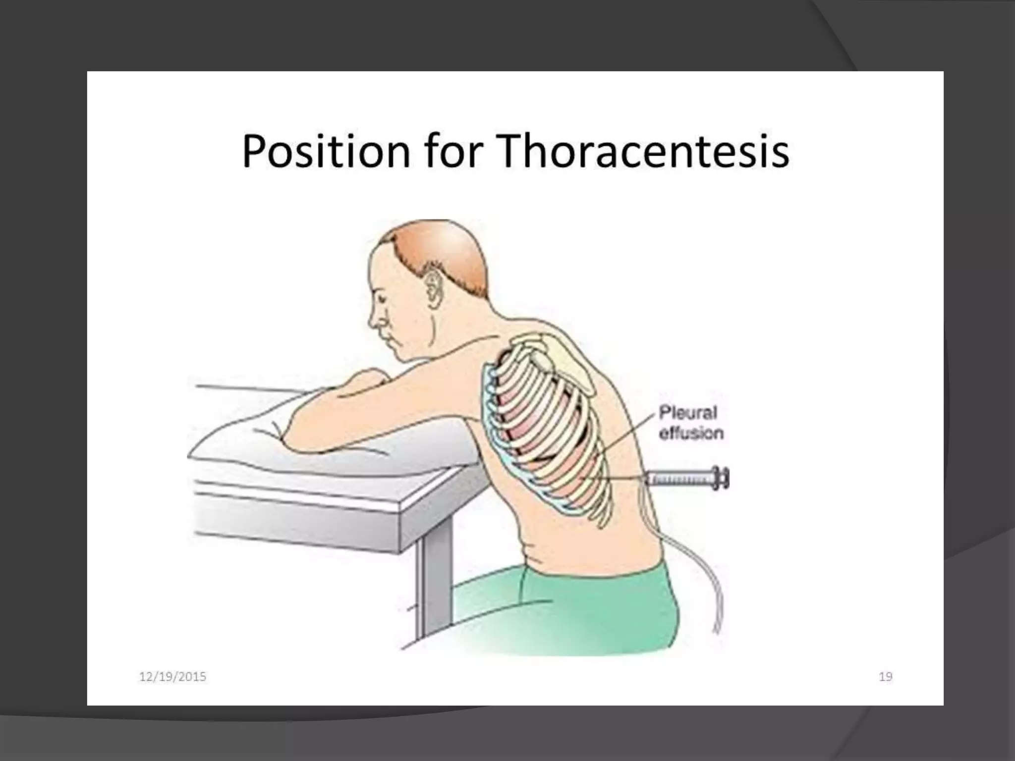 Thoracentesis medical surgical nursing | PPTX