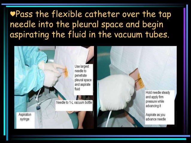 -Thoracentesis.pptx