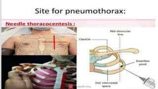 Procedure Practical - thoracentesis.pptx