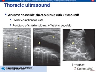 Thoracentesis - pleural effusion for students | PPTX
