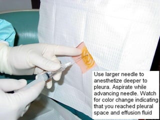 Thoracentesis Needle Size