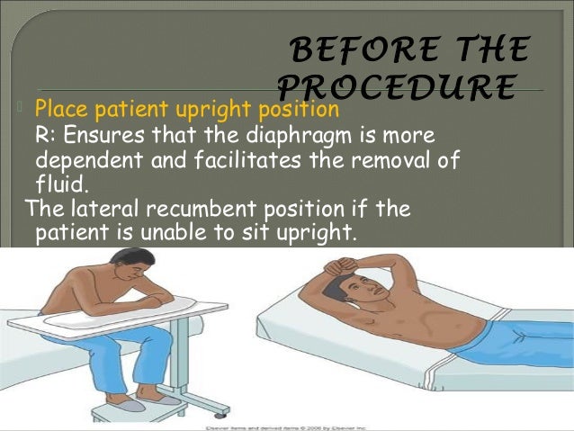 Thoracentesis Procedure