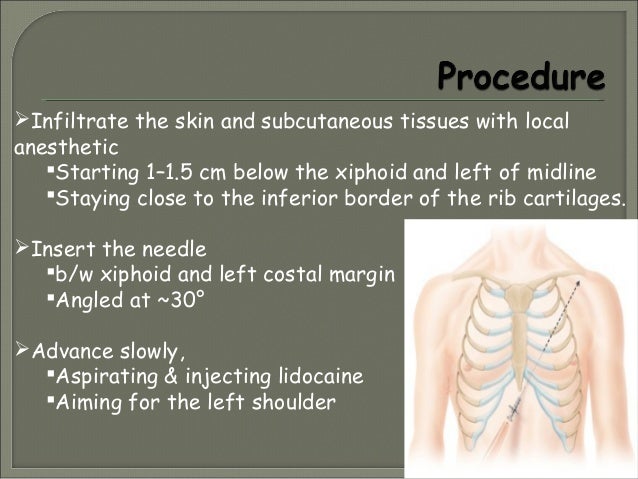 Thoracentesis