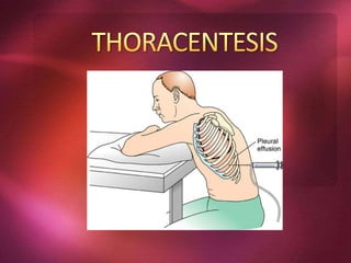 Thoracentesis | PPTX