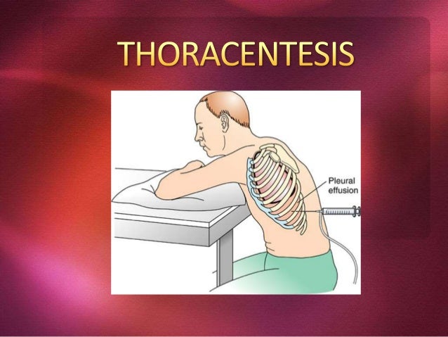 Thoracentesis