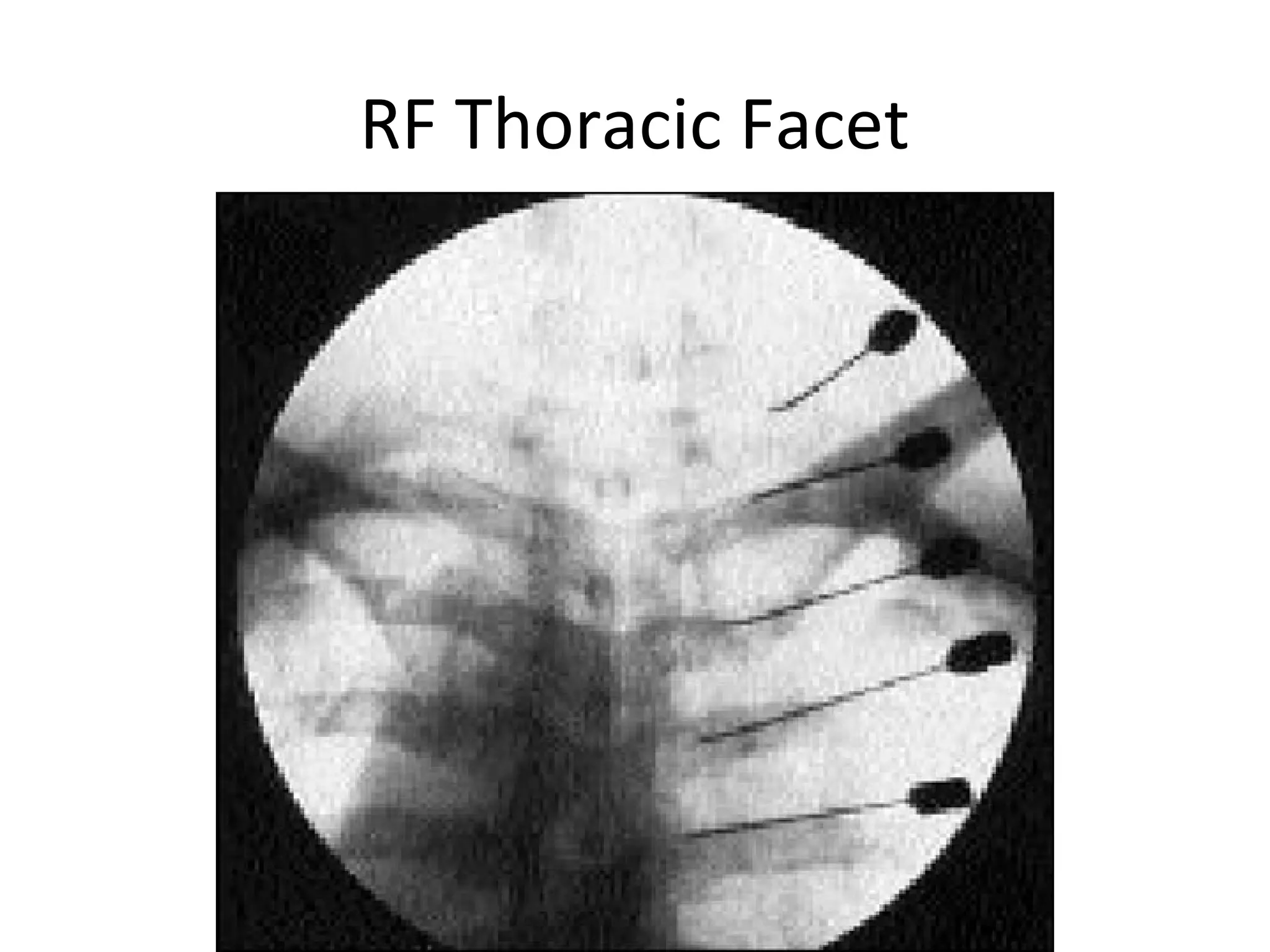 thoracic interventions.ppt