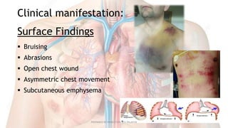 THORACIC-EMERGENCY-TRAUMAS to help us what to do | PPT
