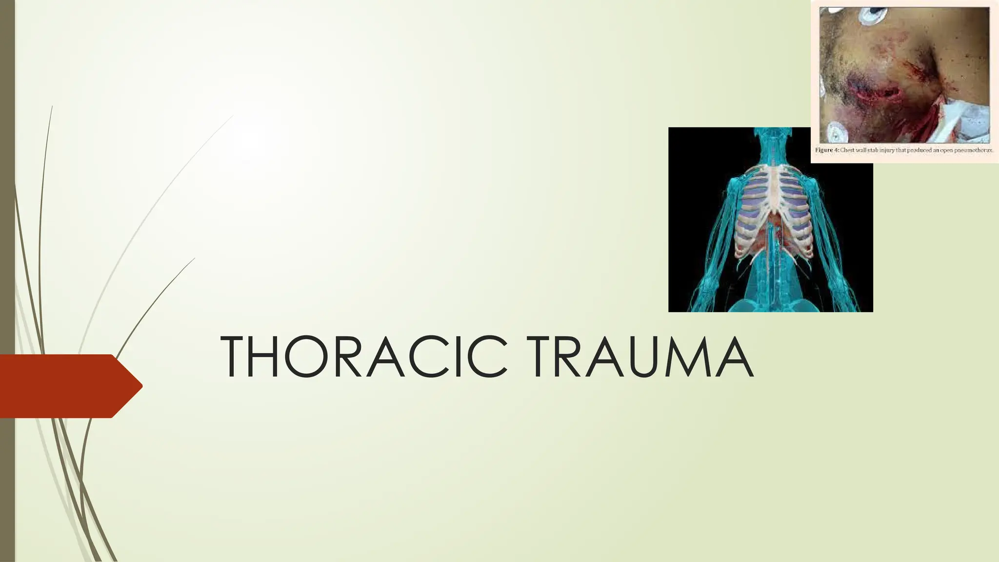 THORACIC-TRAUMA.pptxbjhhuuswfjjjgghkyffuiitfg | PPTX