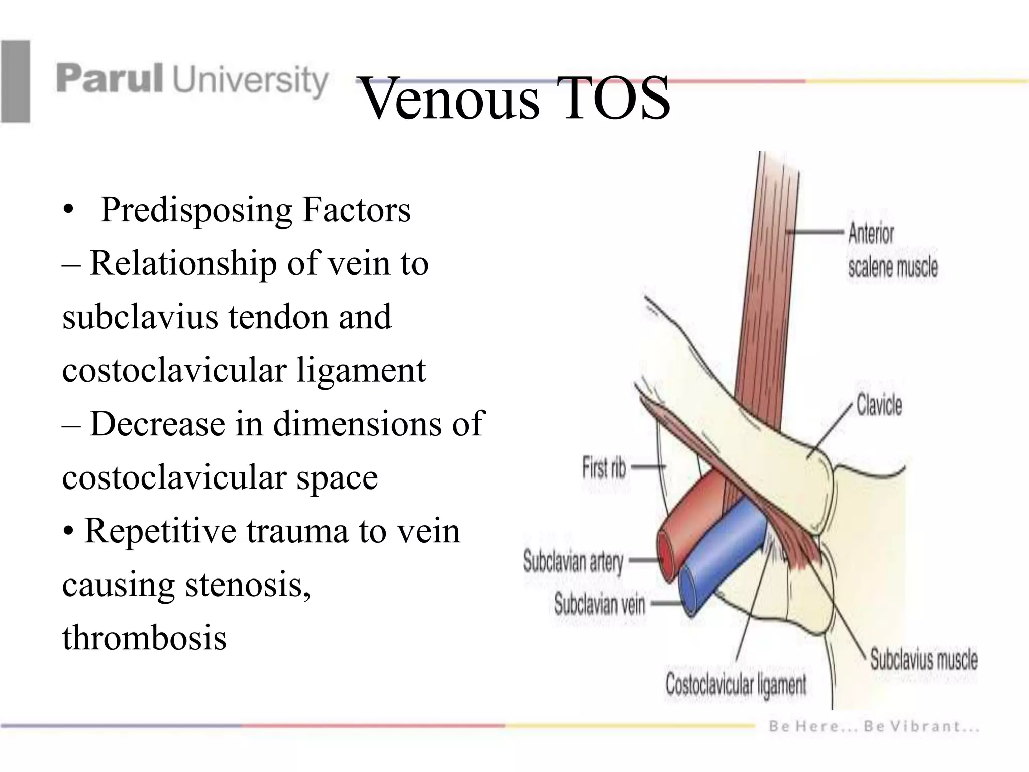 THORACIC%20OUTLET%20SYNDROME.pptx