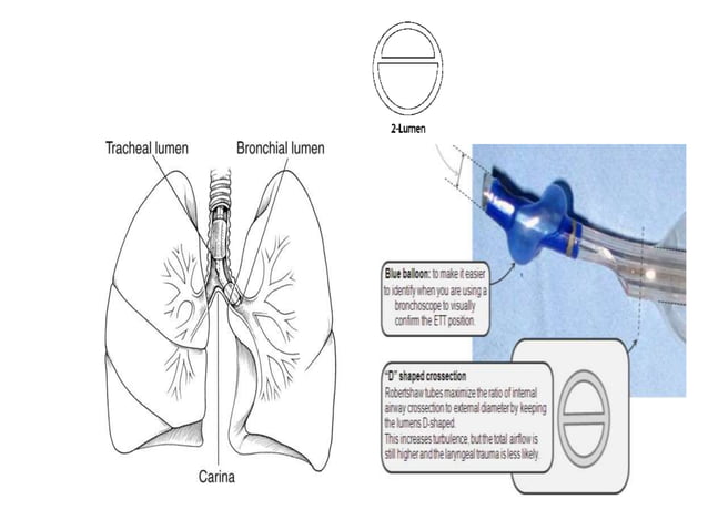 Thoracic anaesthesia One lung ventilation | PPTX | Lung and Respiratory ...