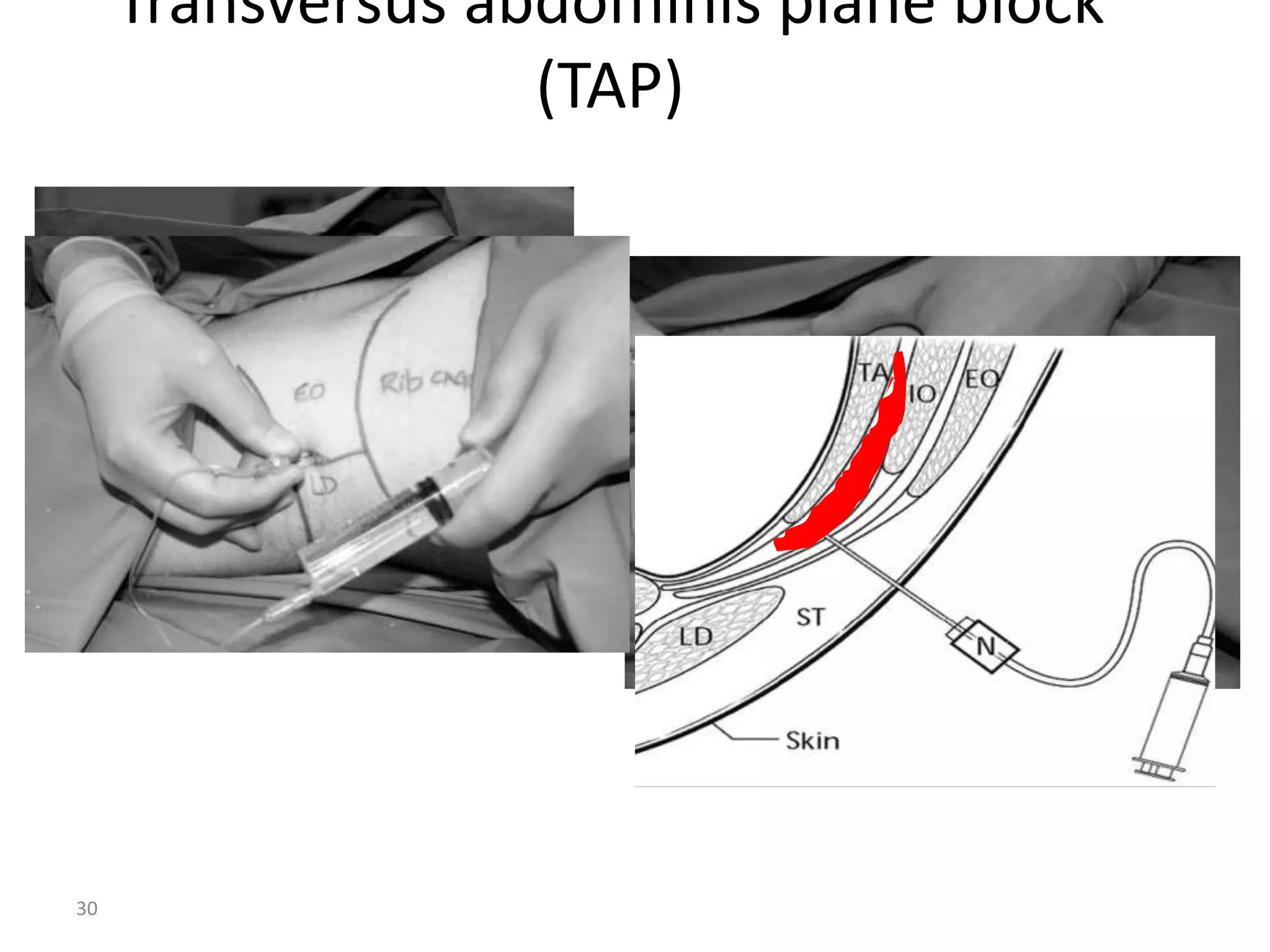 Thoracic and abdominal nerve blocks | PPTX