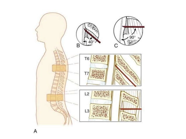 Thoracic and abdominal nerve blocks | PPTX