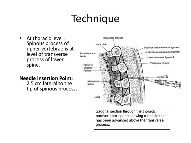 Thoracic and abdominal nerve blocks