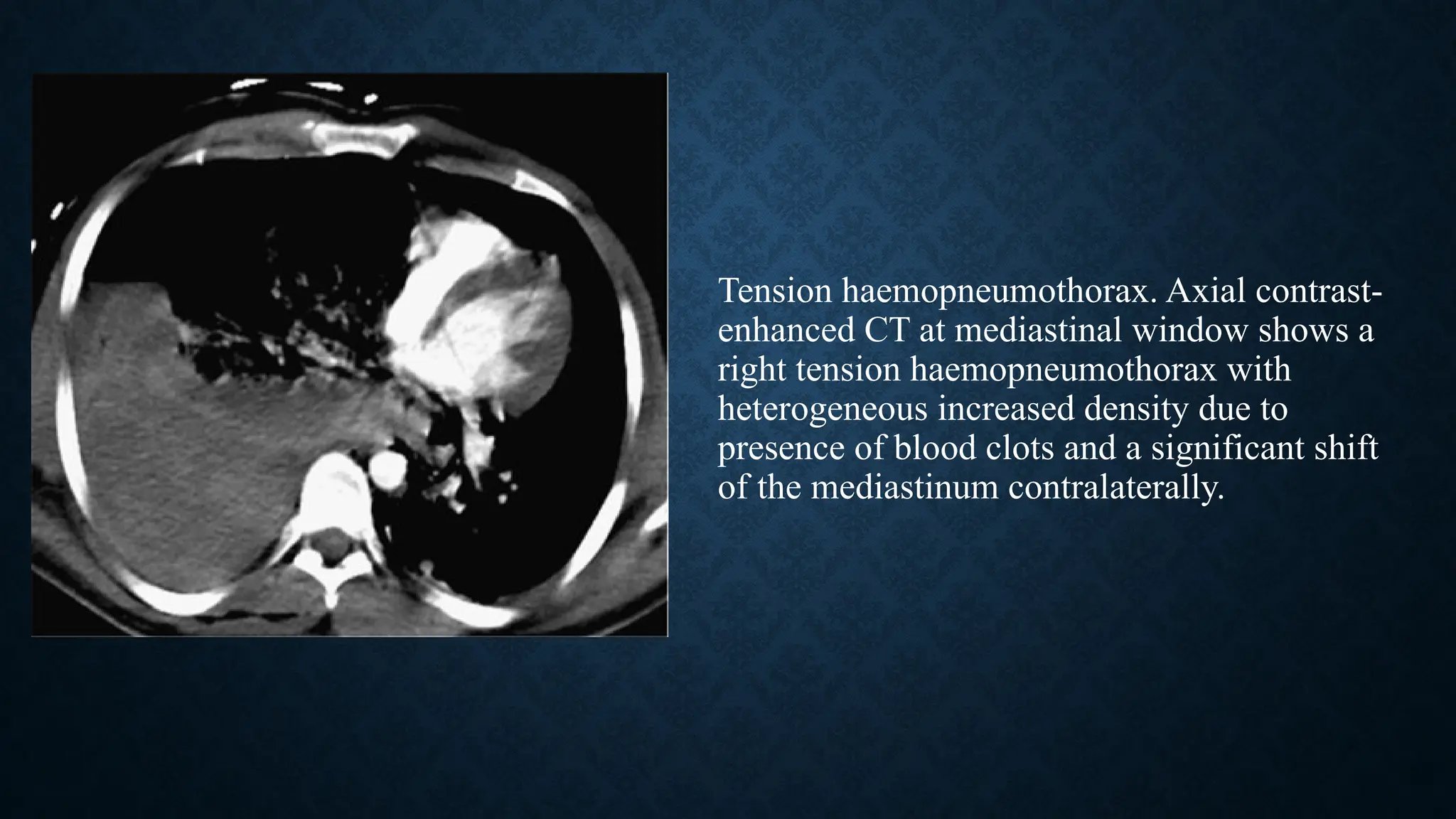thoracic and abdominal trauma radiology finding | PPTX