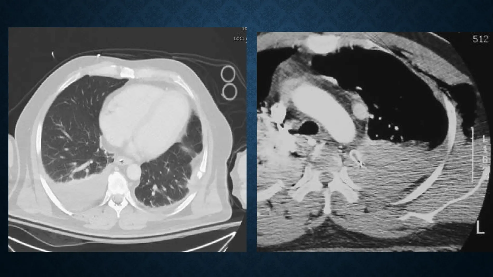 thoracic and abdominal trauma radiology finding | PPTX