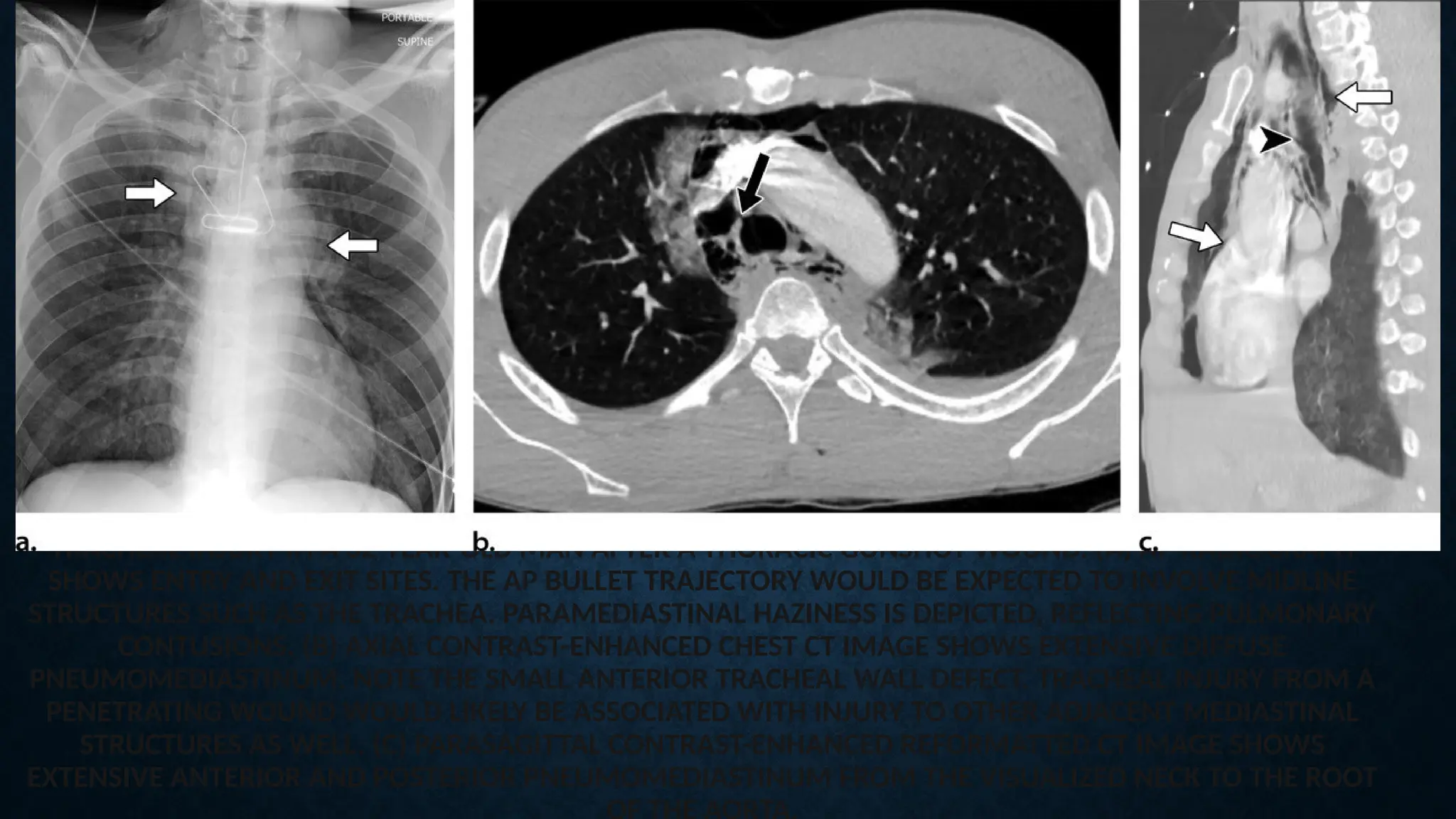 thoracic and abdominal trauma radiology finding | PPTX