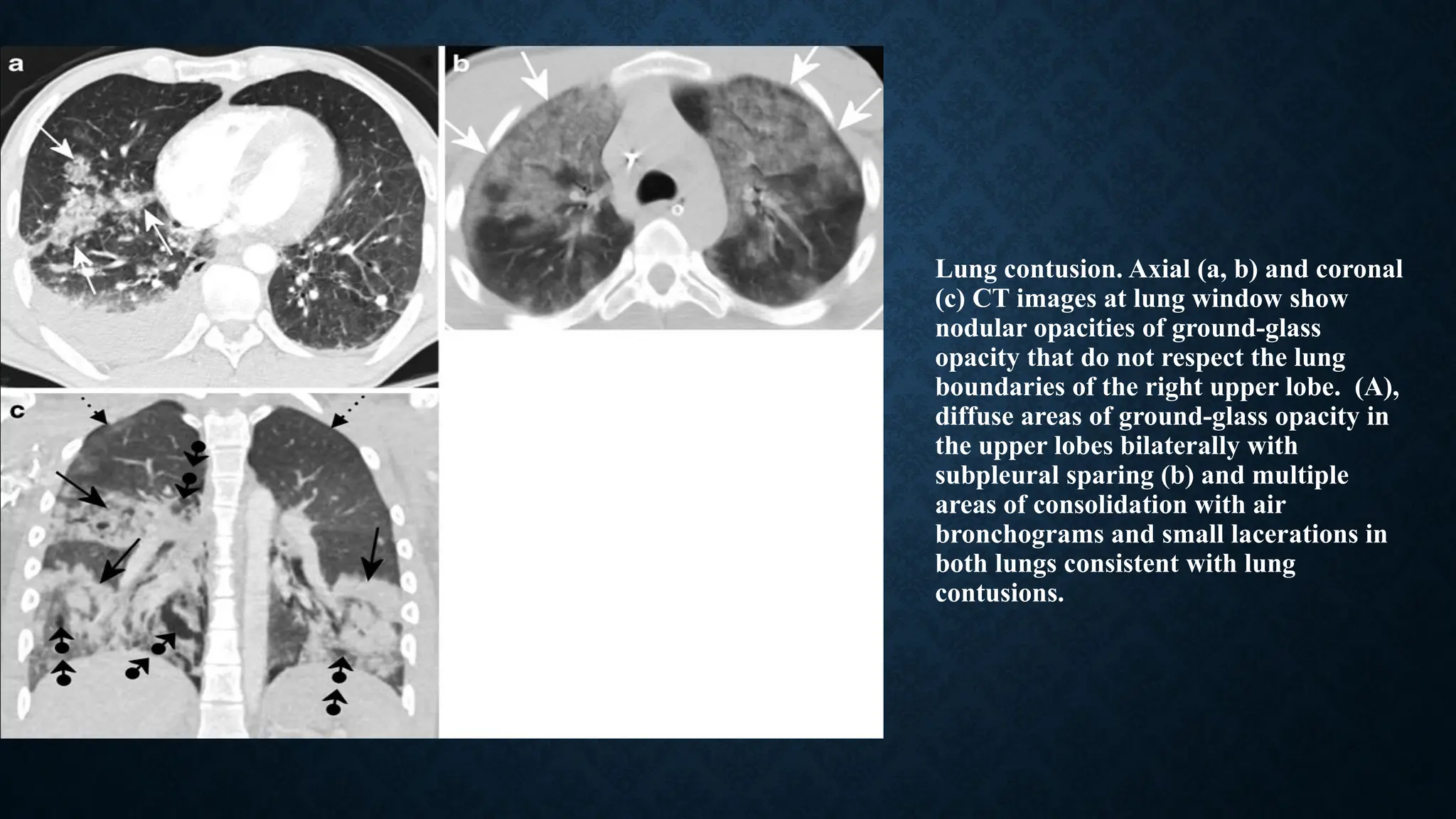 thoracic and abdominal trauma radiology finding | PPTX