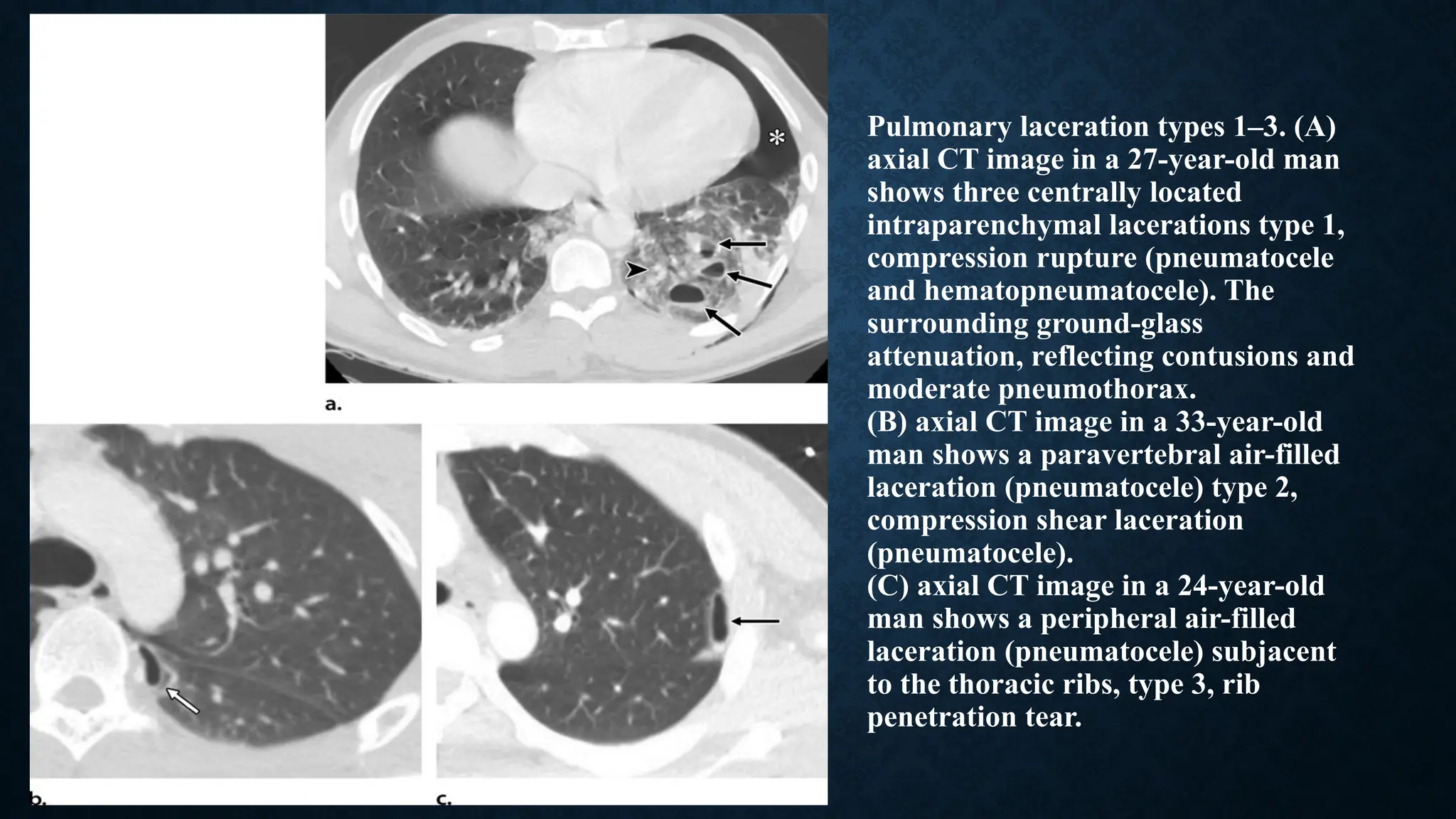 thoracic and abdominal trauma radiology finding | PPTX