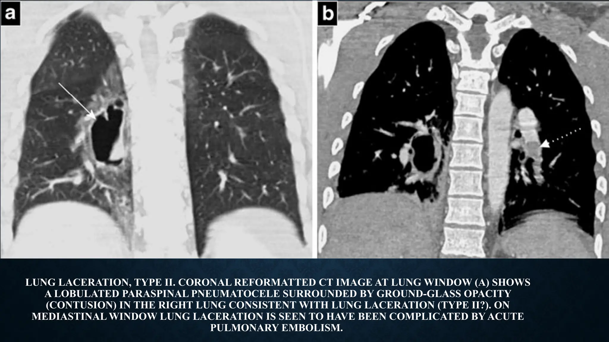 thoracic and abdominal trauma radiology finding | PPTX