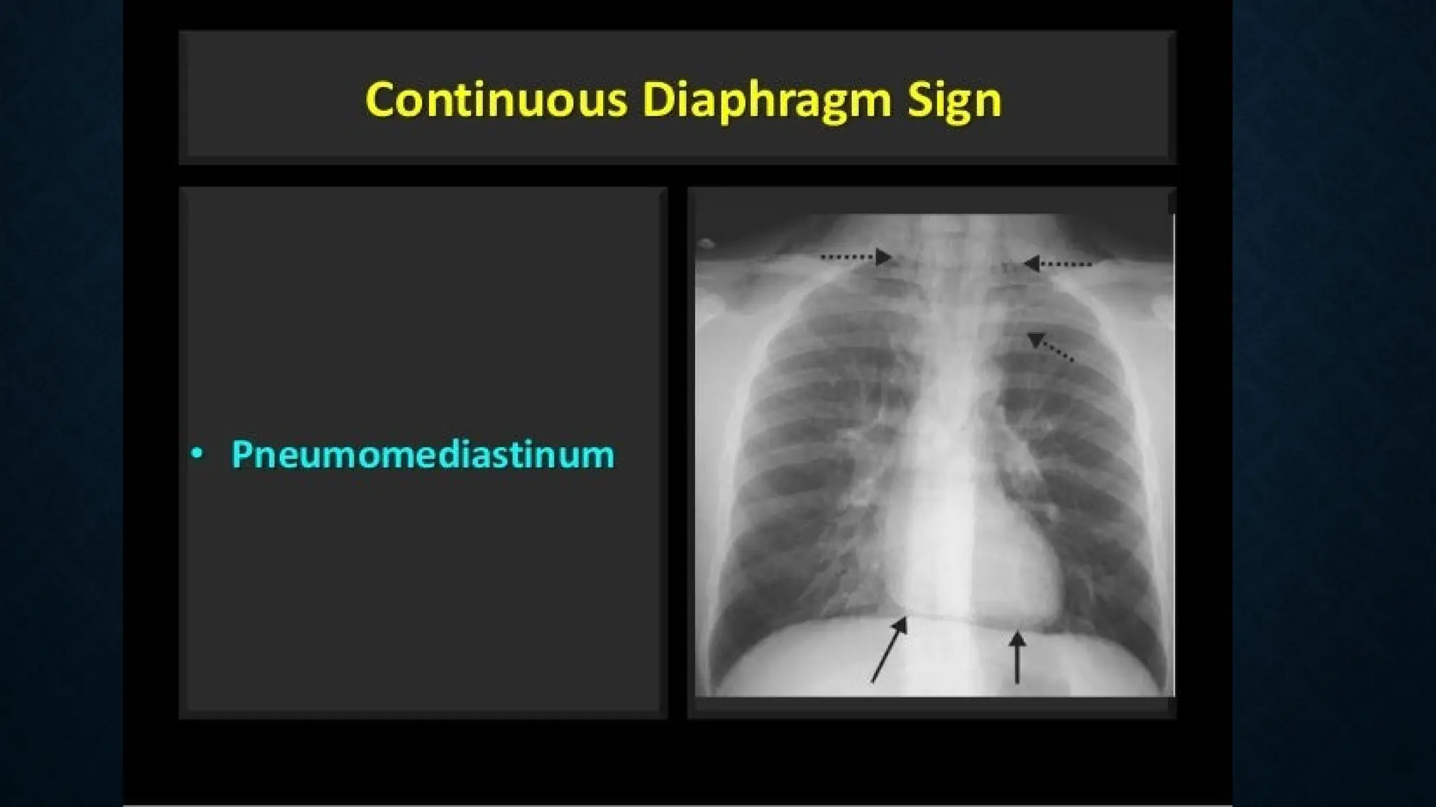 thoracic and abdominal trauma radiology finding | PPTX