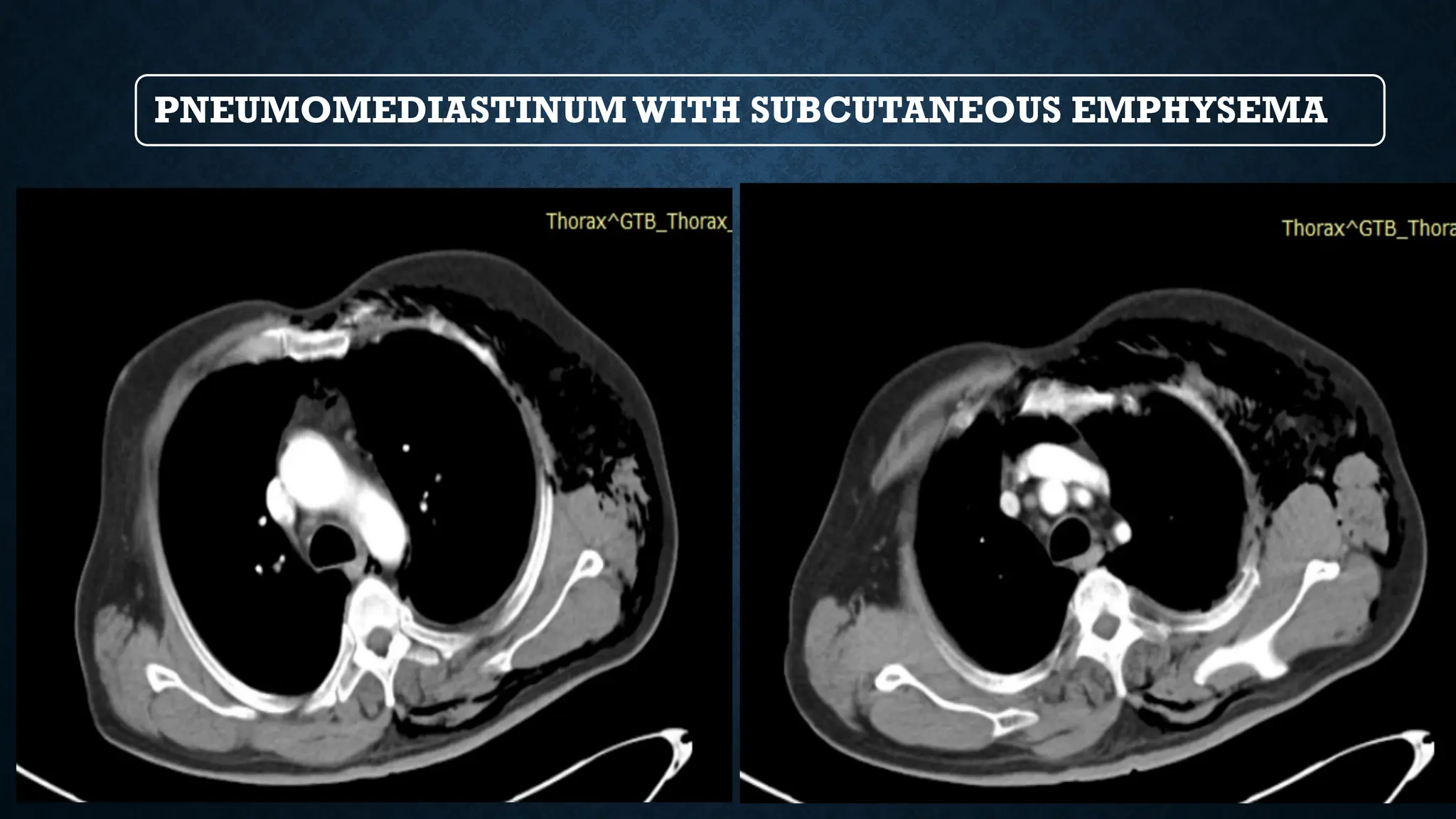 thoracic and abdominal trauma radiology finding | PPTX
