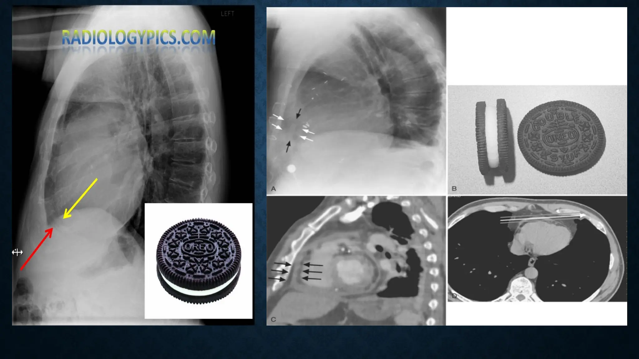 thoracic and abdominal trauma radiology finding | PPTX